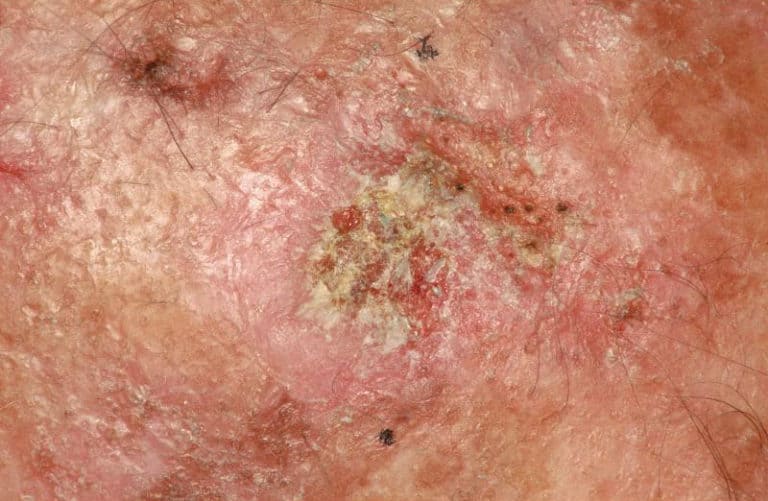 Acheter Picato : prix, avis et recommandations de traitement