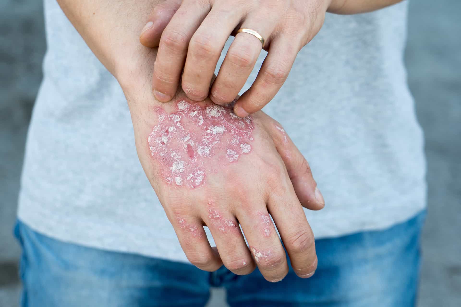 Acheter Dermacort : avis, prix et conseils pour soigner le psoriasis
