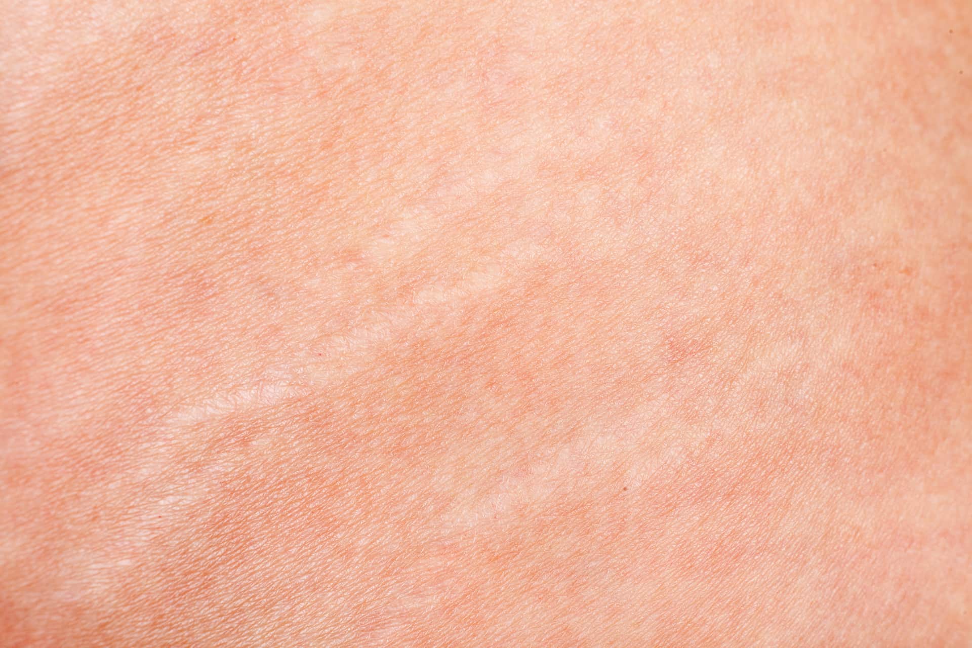 Vergetures : comment en venir à bout ? Nos conseils crèmes et huiles