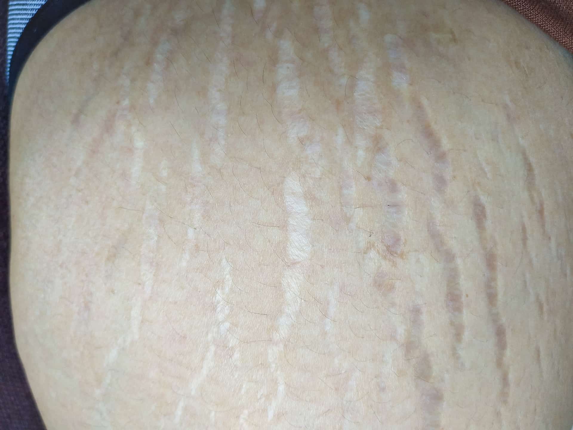 Vergetures : comment en venir à bout ? Nos conseils crèmes et huiles